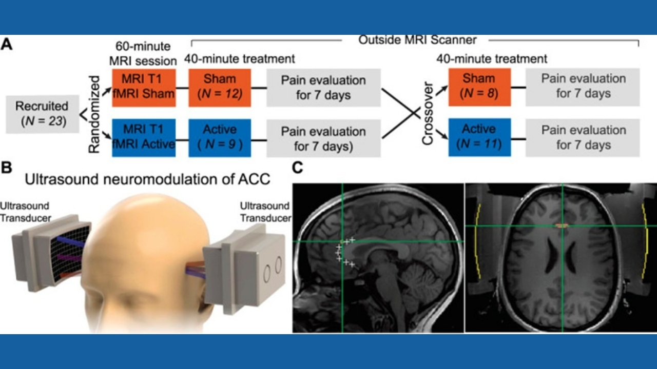 China’s ultrasound brain tech race heats up - CyberGuy