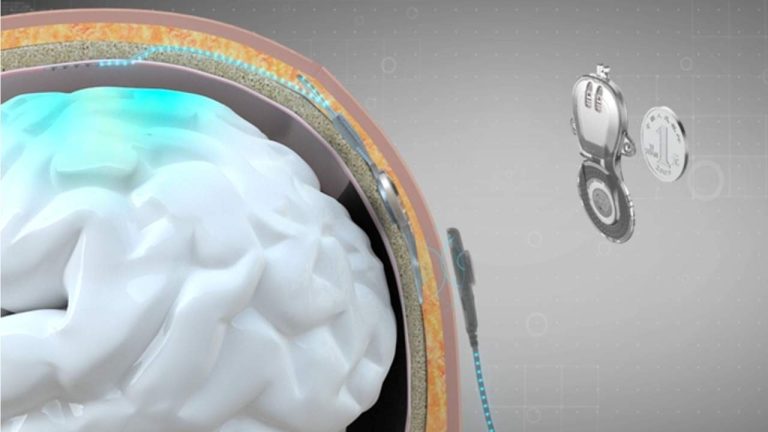 China’s brain chip breakthrough raises big questions - CyberGuy